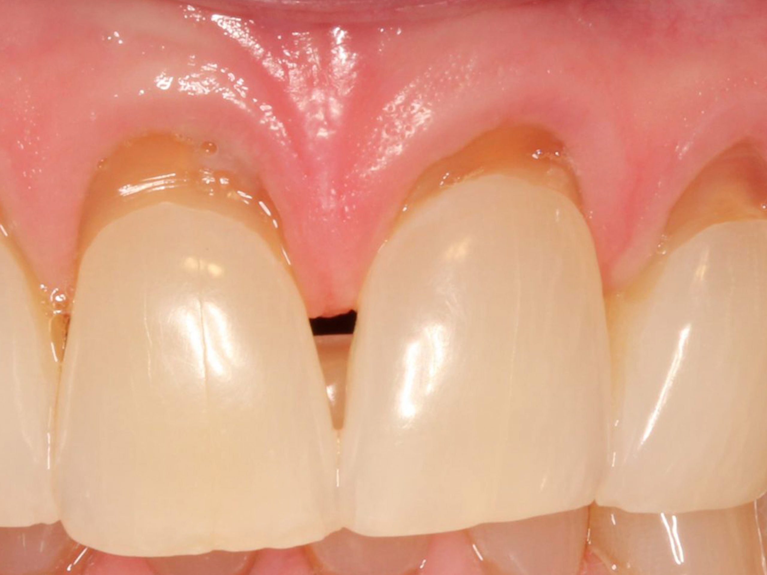 Gum Recession Pinhole Surgical Technique Grafting